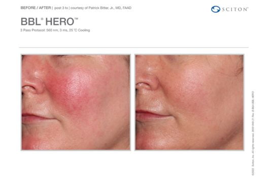 BBL Treatments - Luxe. Salon & Medspa